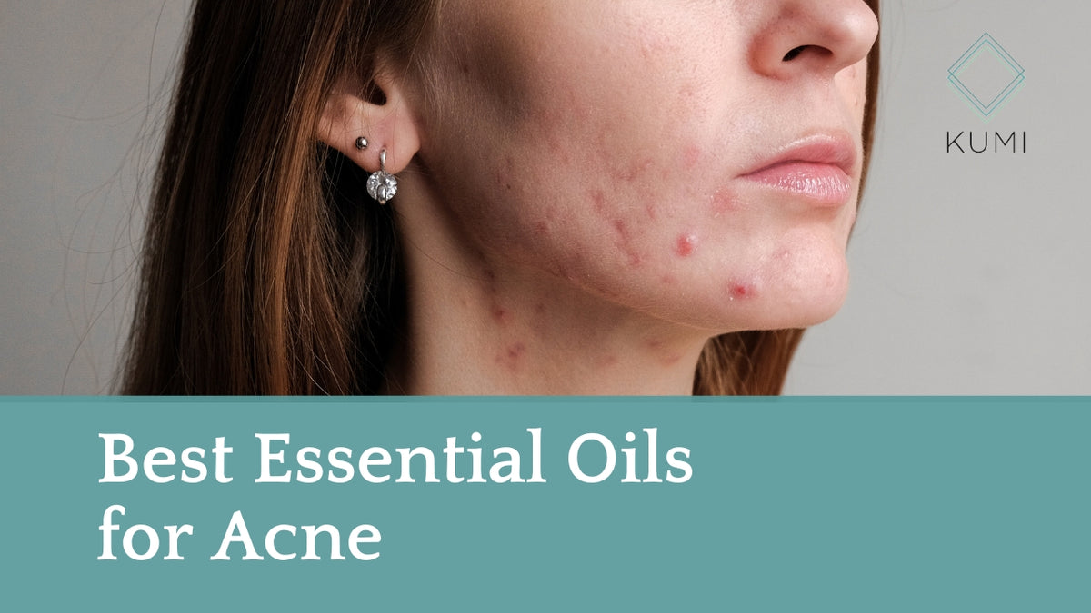 Best Essential Oils for Acne – Kumi Oils